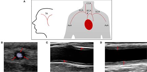 Temporal Artery Ultrasound