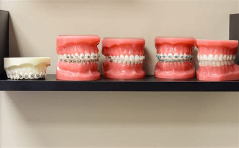 Procedure For Braces Placing Smile Studio Orthodontics Richmond Katy