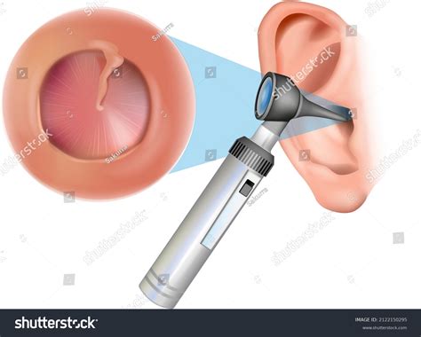 Acute Otitis Media Vs Otitis Media With Effusion