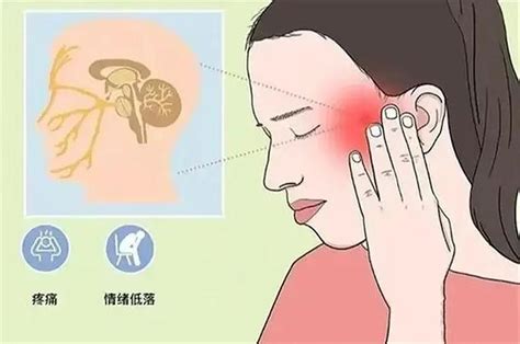怎么判断是不是三叉神经痛？ 知乎