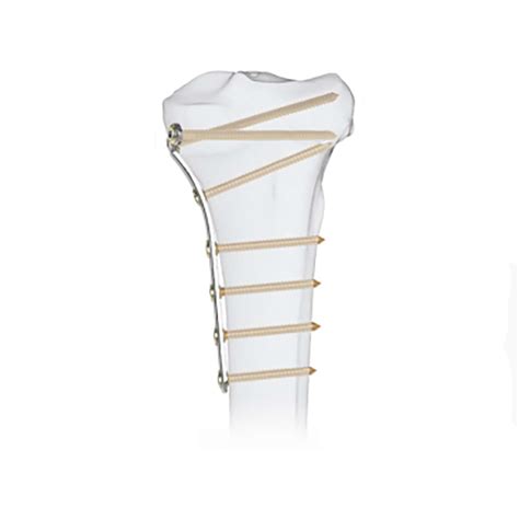 Medial Proximal Tibia Plate Clinilab