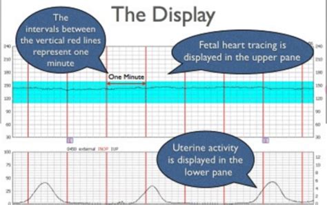 Fetal Heart Tracing Flashcards Quizlet