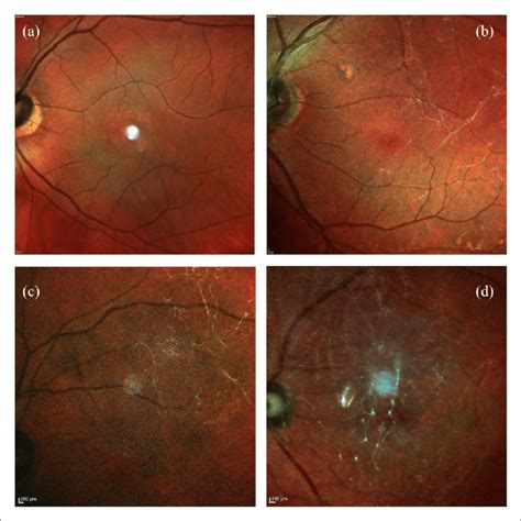 Grading For Severity Of Reticular Pattern On Multicolor Images A The