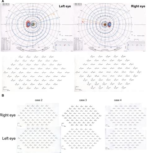 Full Article Pattern Reversal Visual Evoked Potential In Patients With Occult Macular Dystrophy