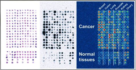 Tissue Microarrays For Miniaturized High Throughput Molecular Profiling