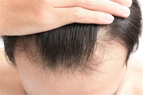 Simple Ways To Help Prevent Hair Loss In Men Fitneass