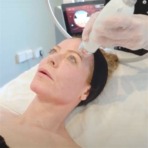 Whats The Buzz About Radiofrequency Microneedling The Tweakments Guide