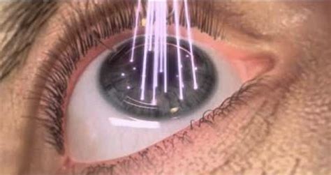 7 Things About Lasik Surgery