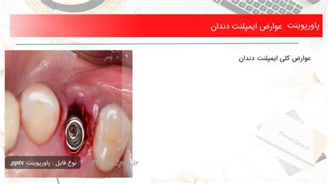 دانلود پاورپوینت عوارض ایمپلنت دندان کد108133