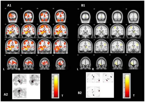 Vbm Demonstrated Significant Areas Of Diffuse Gray Matter Volume Loss