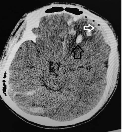 Non Contrast Ct Head Axial View Brain Window Demonstrates Multiple Post