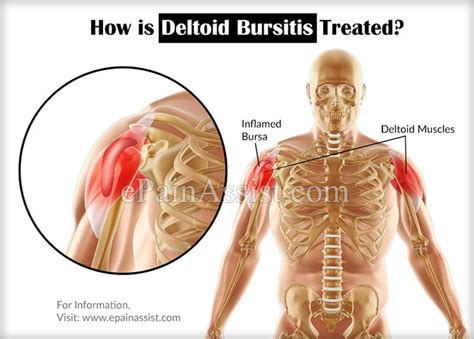 What Is Deltoid Bursitis Know Its Treatment Recovery Exercises