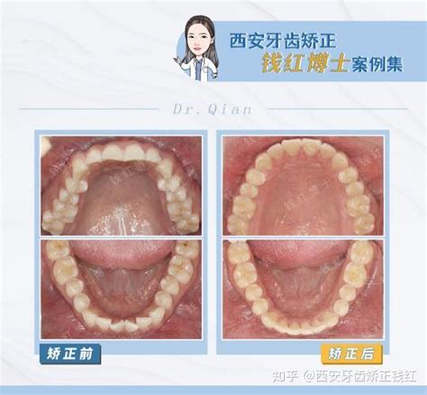 西安整牙整牙可以解决磨牙吗？磨牙的成因是什么？ 知乎