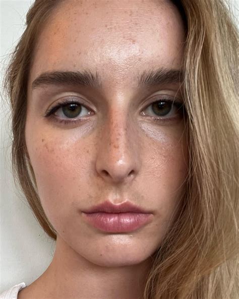 Upper Lip Melasma Rmelasmaskincare