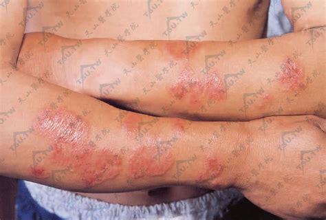 皮肤病学 天山医学院