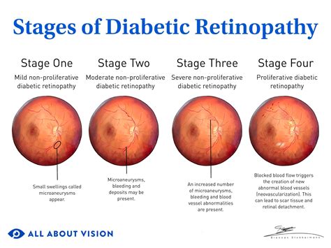 Diabetes Related Macular Edema Causes Symptoms And Treatments