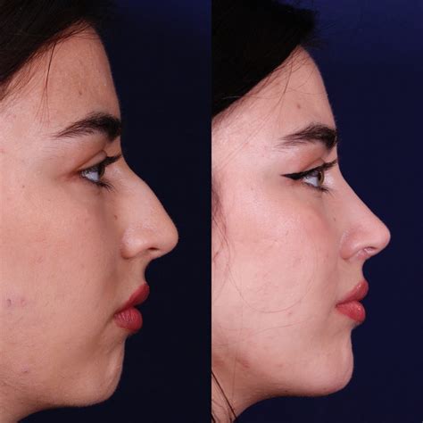 【18 Types Of Noses What They Are And Differences 2025】