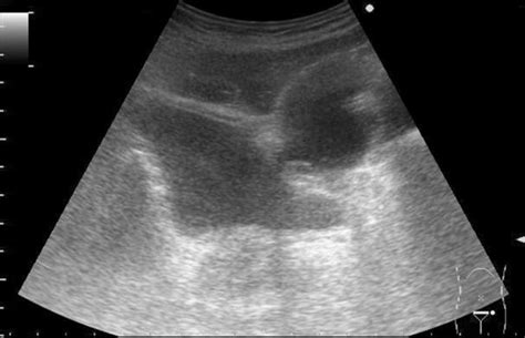 Transverse Transabdominal Grayscale Sonogram Of The Pelvis Showing A