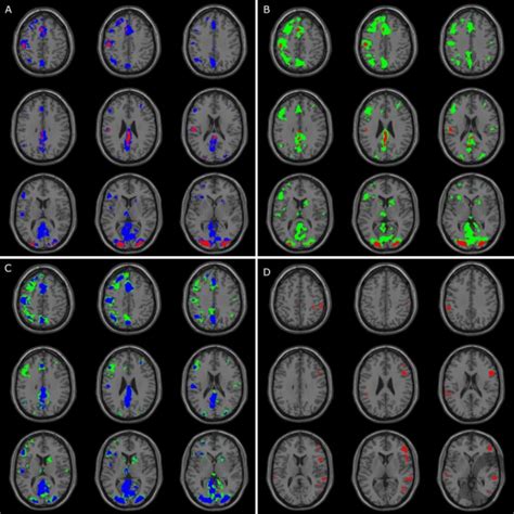 The Activation Maps Found In Ica Aroma 1regression Red And Download Scientific Diagram