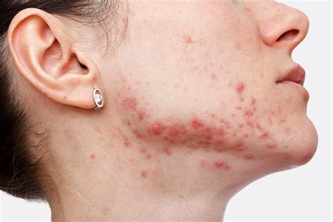 Post Inflammatory Hyperpigmentation PIH Eucerin