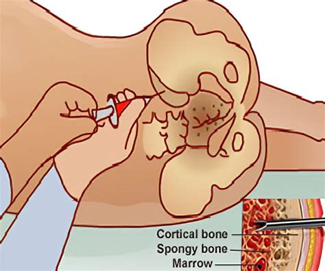 Bone Marrow Biopsy Sample