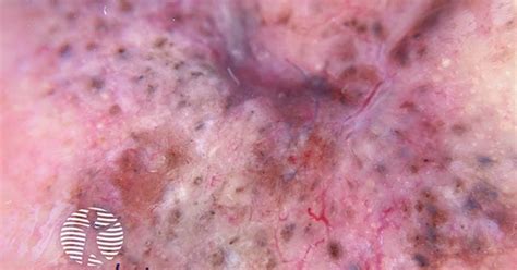 Basal Cell Carcinoma Image