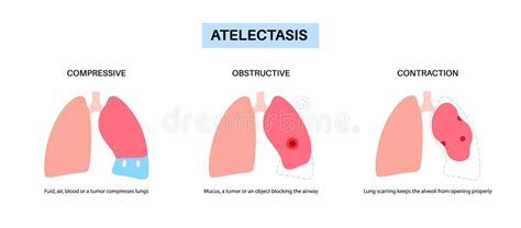 Atelectasis Medical Poster Stock Vector Illustration Of Alveolar