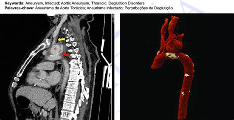 Contrast Enhanced Thoracic Ct With Sagittal Reconstruction