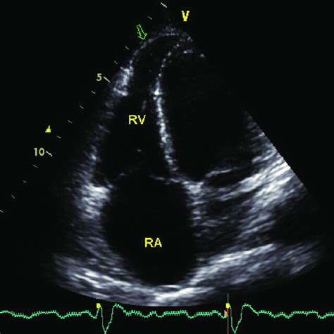 Biventricular Dysfunction In A Patient With Chagas Disease Superior Download Scientific