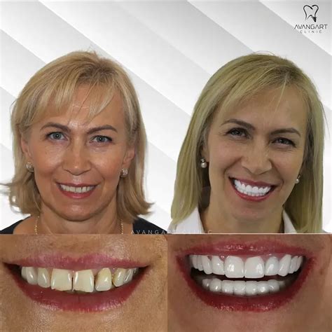 8 Signs Your Teeth Are Shifting Causes Prevention And Treatment
