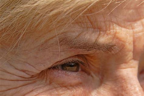 Crows Feet Causes Crows Feet Causes Treatment And Prevention Doeury
