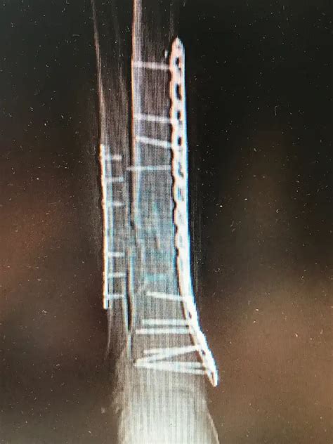 Pseudoartrosis De Tibia Utcvitoria