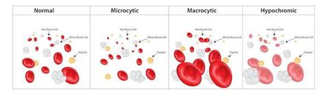 Anemia Kenali Faktor Risiko Ukm Medical Molecular Biology Institute