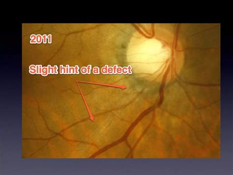 imaging in the detection of glaucoma ppt eye and vision conditions