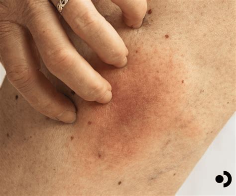 Understanding Allergic Reactions From Insects A Scientific Overview
