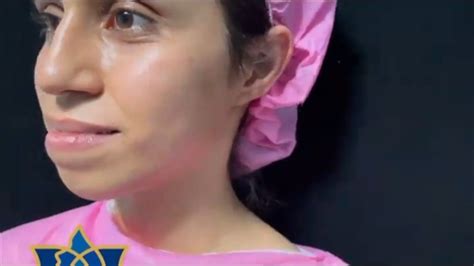 جراحی همزمان فک و چانه نماشا
