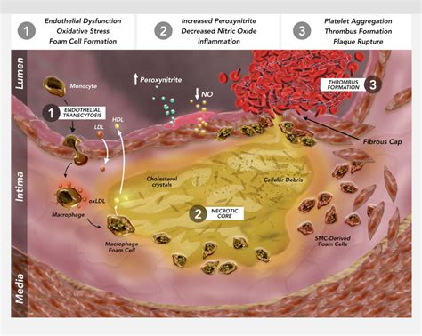 Atherosclerosis Plaque