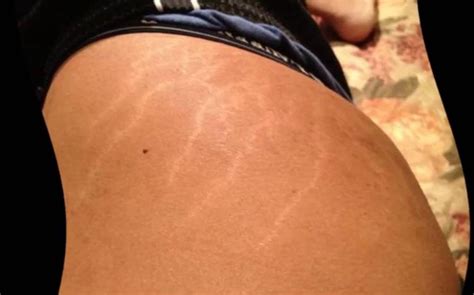 Stretch Marks On Hips Causes And Treatment Healthyesta