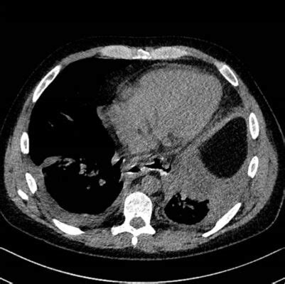 Iatrogenic Perforation After ESD EVT Academy