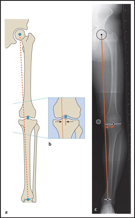 Lower Limb Alignment Radiology Key