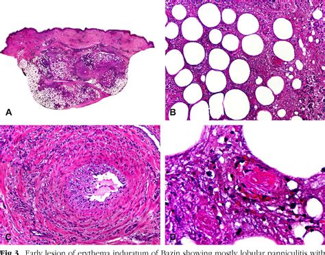 Erythema Induratum Histopathology