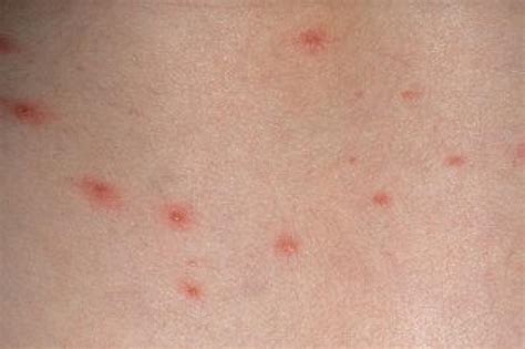 Tanda Tanda Chicken Pox Adrian Clark