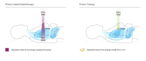 About Proton Radiation Therapy Uams Health
