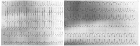 The Heart 🔴 Pre Excited Atrial Fibrillation In