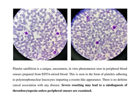 Platelet Satellitism Rare Cause Of Pseudothrombocytopenia Bahria