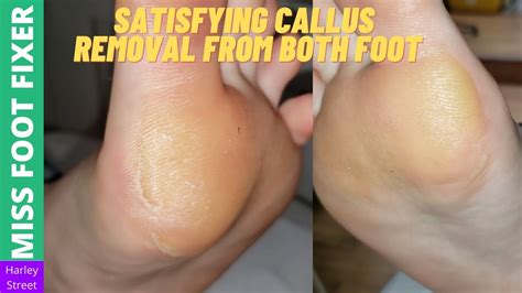 Satisfying Callus Removal Both Feet Miss Foot Fixer Youtube