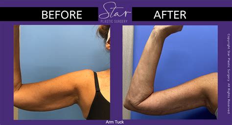 Arm Tuck Right Ant Star Plastic Surgery Star Plastic Surgery