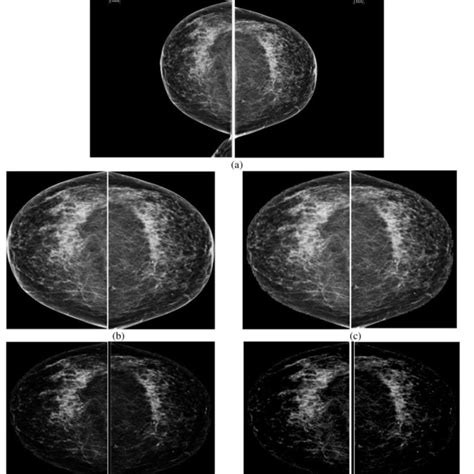 Proposed Pre Processing Segmentation Of Bilateral Cases A The Download Scientific Diagram