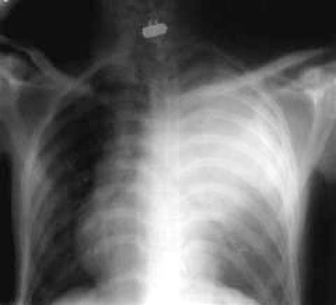 X Ray Chest Pa View Showing Homogenous Opacity In Left Upper And Middle