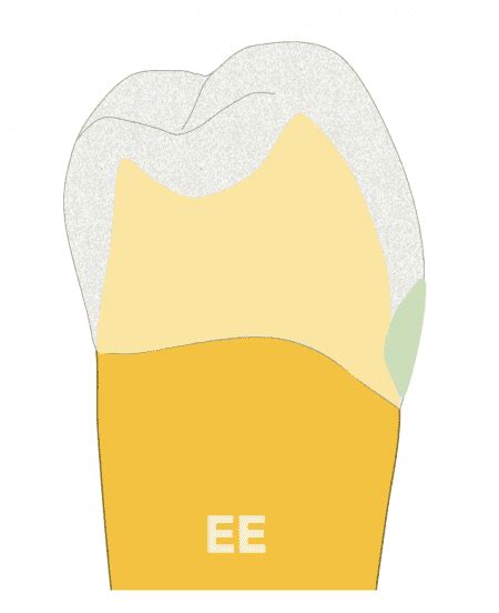 Composite Class V Restorations Lesion Specific Approaches